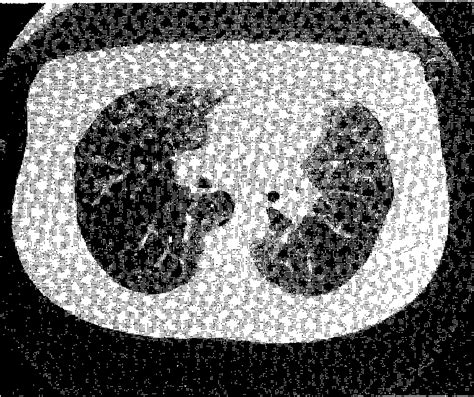 Figure 5 From Follicular Bronchiolitis Associated With Rheumatoid