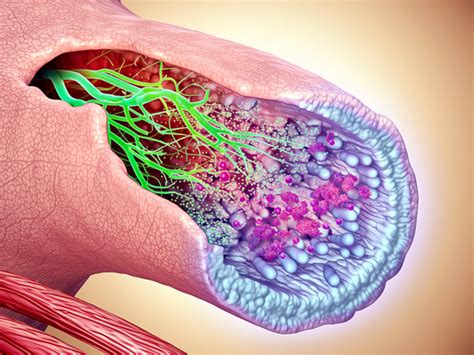 杯状细胞腺癌为什么容易被误诊为阑尾炎 杯状细胞腺癌 阑尾癌 肿瘤疾病大全癌症肿瘤科普知识 有来医生