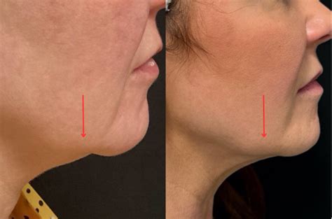 Sofwave Before And After Photos Wisconsin Vein Center And Medispa