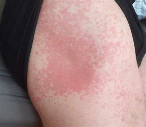 Rash On Buttocks On January 18 2023 By Guest Protected By Copyright