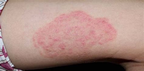 Rash On Inner Thighs Artofit