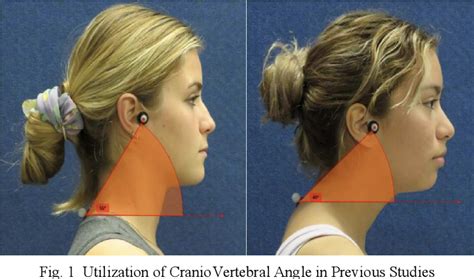 Figure 1 From Forward Head Posture Classification Using Deep Learning