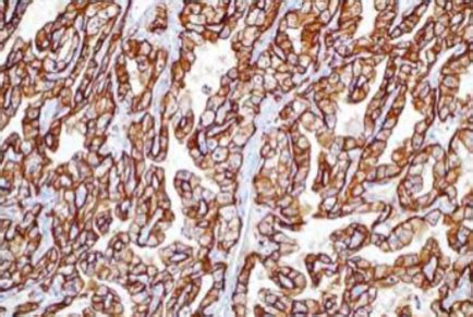 IHC Staining Pattern Flashcards Quizlet