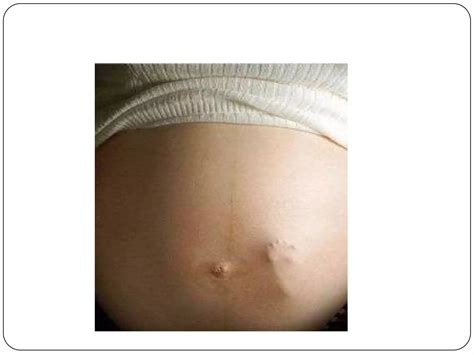 Post Partum Hemorrhage Pptx Post Partum Hemorrhage Pptx