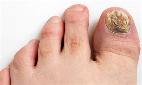 Toenail Fungus Treatment At We Treat Feet Podiatry