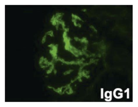 Renal Biopsy Showing Deposition Of Immunoglobulin G Igg And Download Scientific Diagram