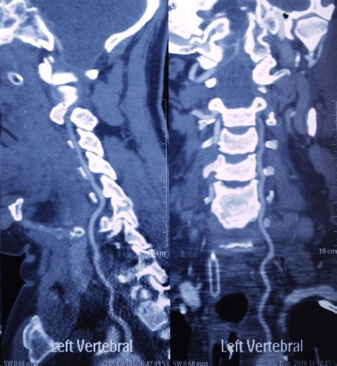 Absent Flow In V3v4 Segment Of Left Vertebral Artery Download Scientific Diagram