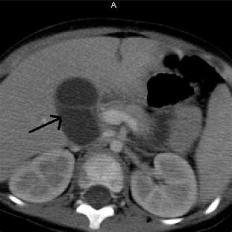 Abdominal Computerized Tomographic View Of Gallbladder Hydrops Arrow