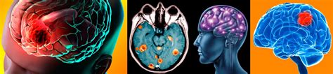 Sistema Nervioso Central Neurocirugía Jaen