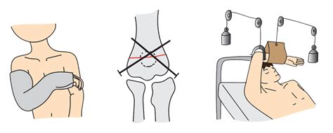 上腕骨顆上骨折とは？原因・症状・治療法を詳しく解説
