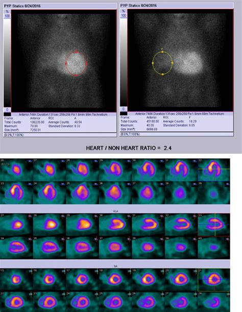 A And B H Cl Heart Contralateral Lung Lung Ratio Methodology With Download Scientific Diagram