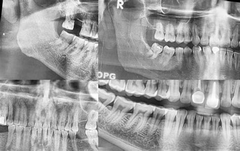 Dental Disease Prediction Object Detection Dataset And Pre Trained Model By My Projects