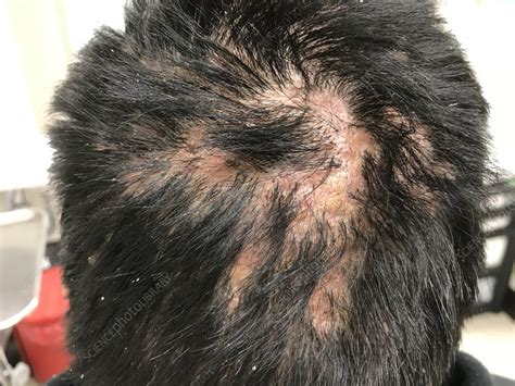 Dissecting Cellulitis Stock Image C060 2979 Science Photo Library