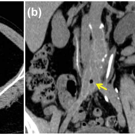 Aortic Graftsmall Intestinal Fistula A Adhesion Of The Prosthetic