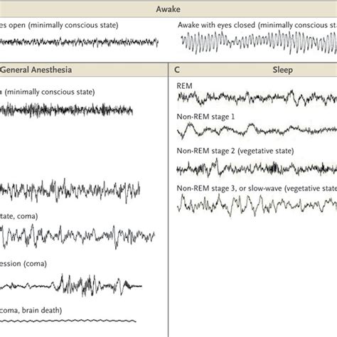 PDF General Anesthesia Sleep And Coma