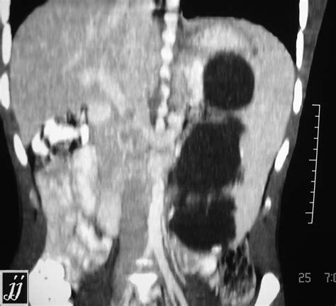 Abdomen Lipoma Of Interface Of Spline Stomach And Bowel 4 Radioogle