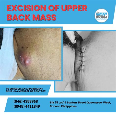 Queens 𝐄𝐱𝐜𝐢𝐬𝐢𝐨𝐧 𝐨𝐟 𝐔𝐩𝐩𝐞𝐫 𝐁𝐚𝐜𝐤 𝐌𝐚𝐬𝐬 A Noticeable Mass On The Upper