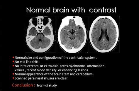 Normal Brain Ct Anatomy