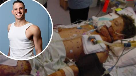 Why Measles Meningococcal Cases Are Rising In Australia How To Stay Safe Gold Coast Bulletin