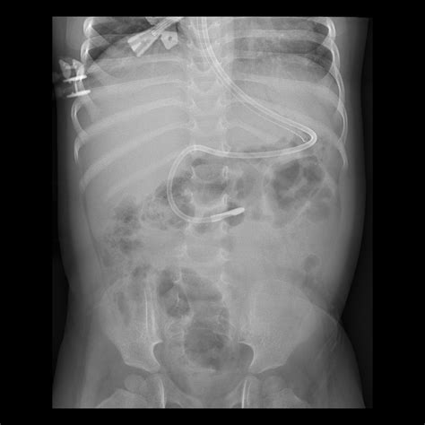 Pediatric Feeding Tube Malfunction Malposition Misposition