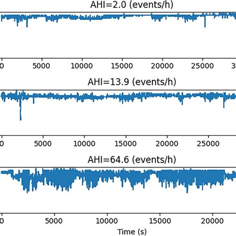 Examples Of Spo2 Signals Of Upper A Subject Without Sleep Apnea Download Scientific Diagram