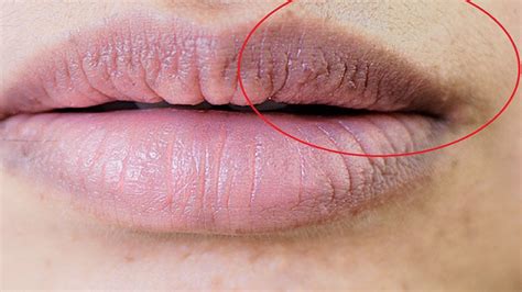 How To Get Rid Of Hyperpigmentation On Lips At Roderick Wilkerson Blog
