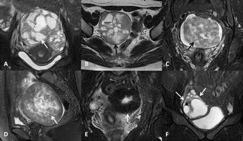 Combination Of Clinical And Mri Features In Diagnosing Ovarian