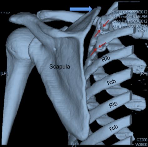 Scapular Bursa Anatomy