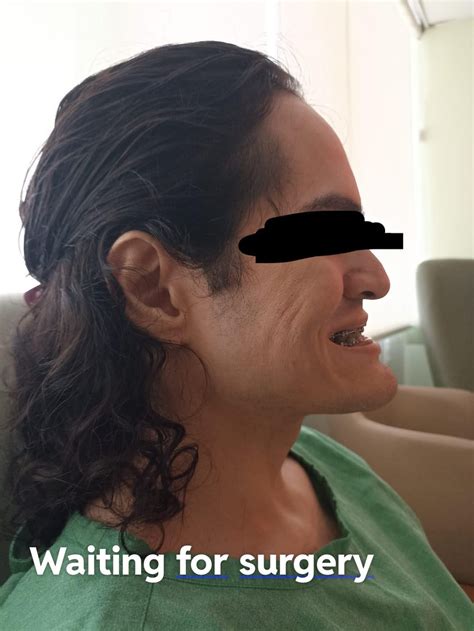 Djw Class 3 Underbite My First Week R Jawsurgery