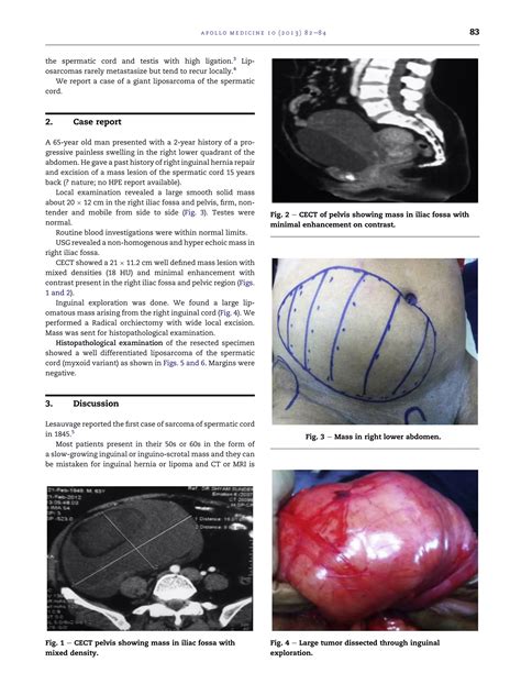 Liposarcoma Of Spermatic Cord A Rare Entity Pdf