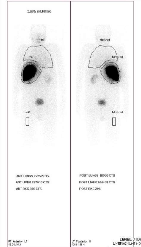 Role Of Nuclear Medicine In Y90 Radioembolization