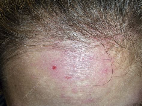 Acute Cutaneous Lupus Stock Image C0608899 Science Photo Library