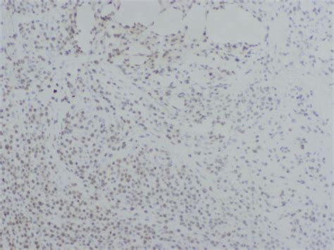 Ectomesenchymal Chondromyxoid Tumor Report Of A Case With Description