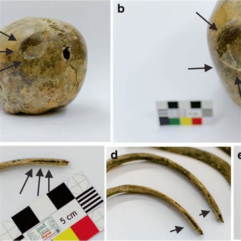 Perimortem Fractures On Left Parietal A B And Third And Fourth Left