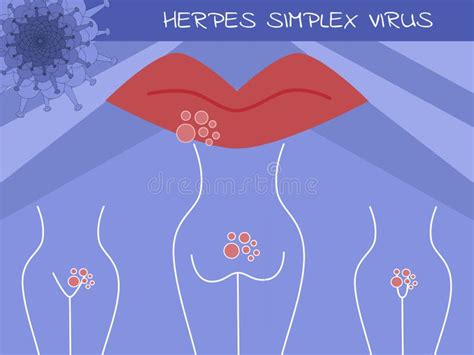 Herpes Simplex Virus Hsv Stock Vector Illustration Of Infographic