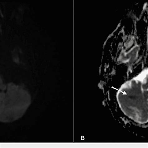 Diffusion Weighted Mri A And Adc Map B Shows Focus Of Diffusion Download Scientific Diagram