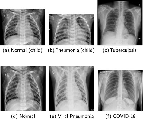 This Breakthrough Ai Can Detect Lung Diseases With 98 Accuracy