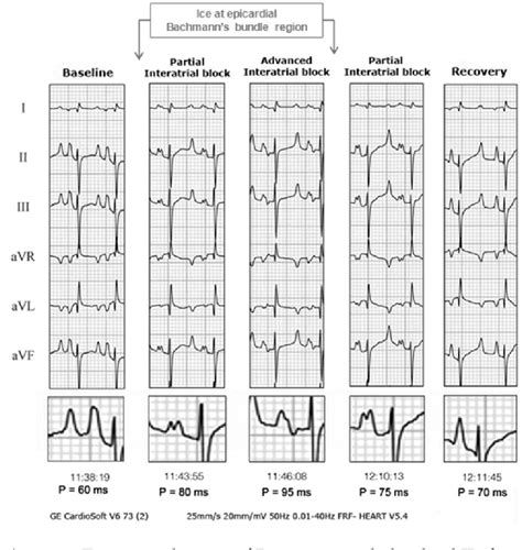 Figure 1 From Current Ecg Aspects Of Interatrial Block Semantic Scholar Figure 1 From Current Ecg Aspects Of Interatrial Block Semantic Scholar
