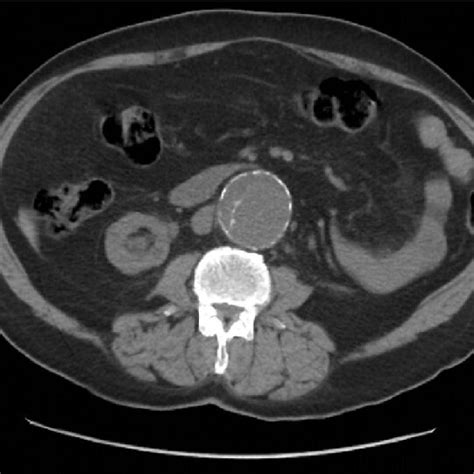 Ct Scan With Contrast Comparing 2017 And 2020 Showed Marked Expansion