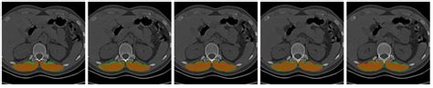Research And Implementation Of Lumbar Muscle Segmentation Based On U Net Network For Ct Images