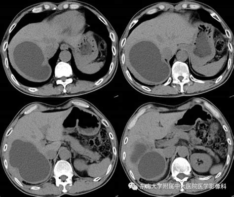 【病例】肝包虫病1例ct影像表现 影像ppt