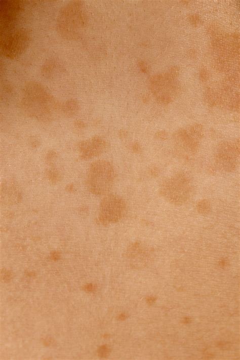 What Are Light Brown Patches On Skin