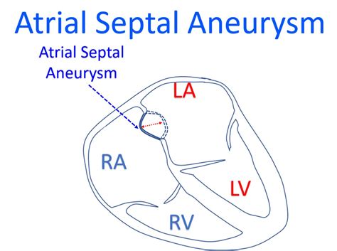 Atrial Septal Aneurysm Floppy Portion Of The Foass Ovalis