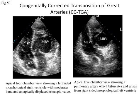 Ppt Congenitally Corrected Transposition Of Great Arteries Cc Tga
