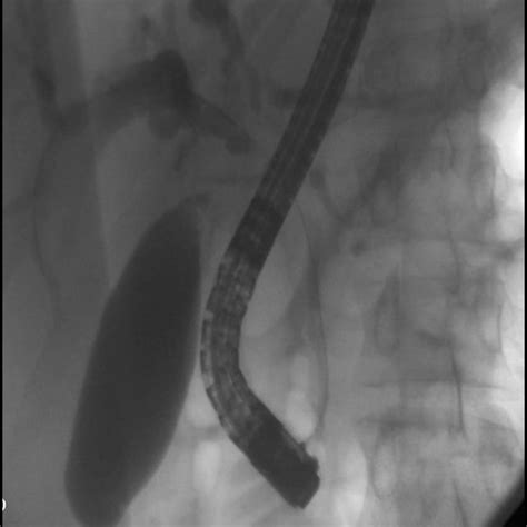 Endoscopic Retrograde Cholangiopancreatography Showing Intrahepatic Download Scientific Diagram