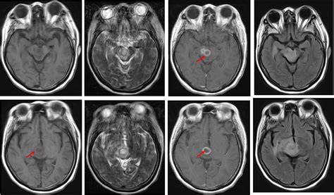 Cerebral Abscess Radiology Cases