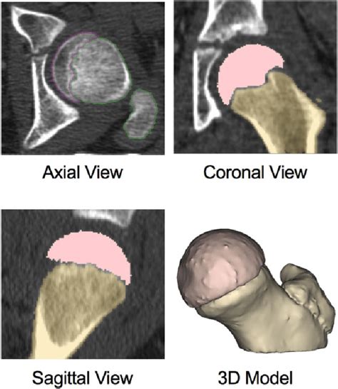 figure a2 3d segmentation and reconstruction of the proximal femur in