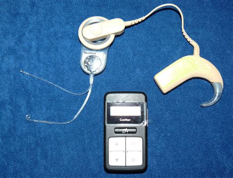 Implante Coclear Blog De Salud