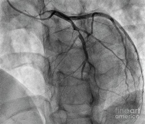 Coronary Artery Stenosis 13 Photograph By Science Photo Library Pixels
