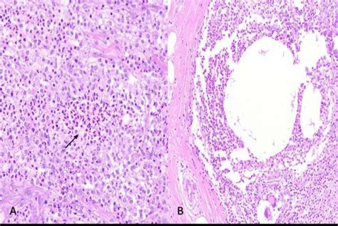A Note The Neutrophilic Microabscess In The Center Of This